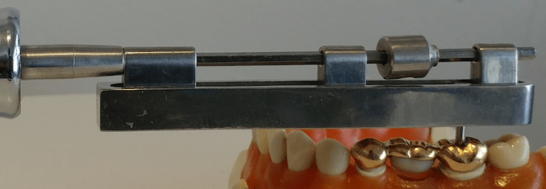 How it works – The Higa Bridge Remover