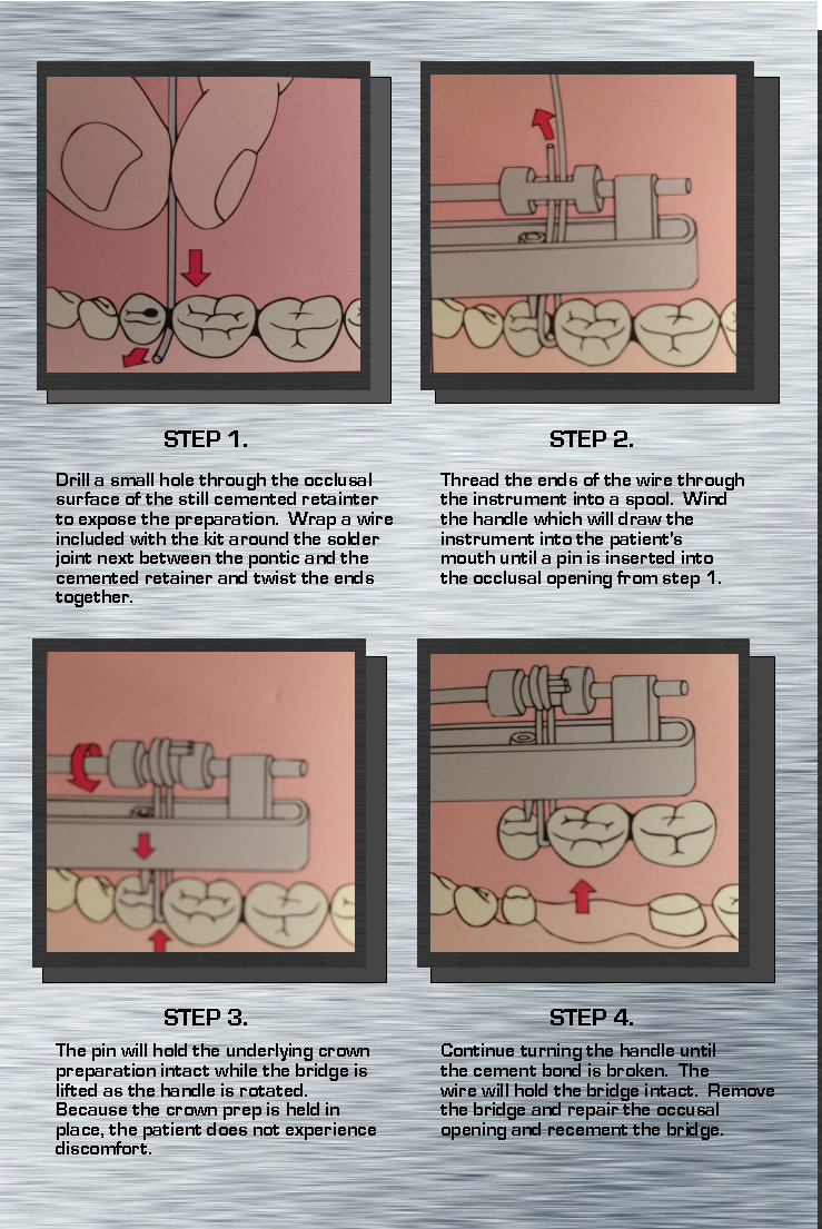 How it works – The Higa Bridge Remover